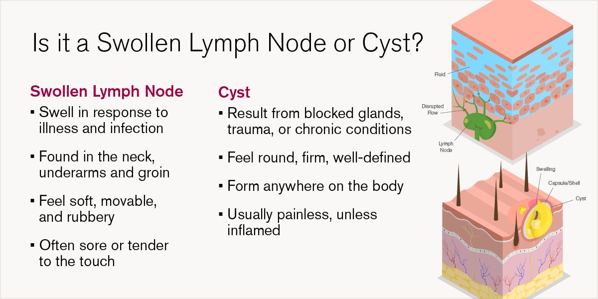 Lymph Nodes vs. Cysts: How to Tell the Difference and When to See a Doctor | Blog | Loyola Medicine
